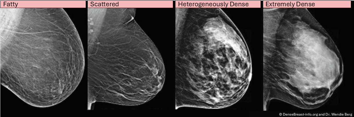 Dense Breast Tissue: Your Common Questions Answered | Radiology Ltd.